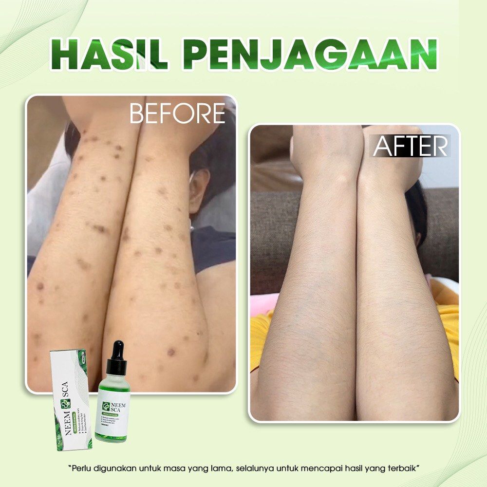 NEEM SCA Scabies Solution Serum original 30ml, Eliminate itchy red skin ...