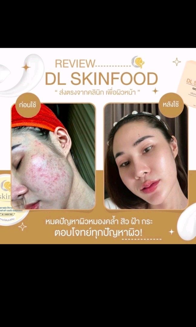 Deli skin care night cream acne/melasma, Beauty & Personal Care, Face ...