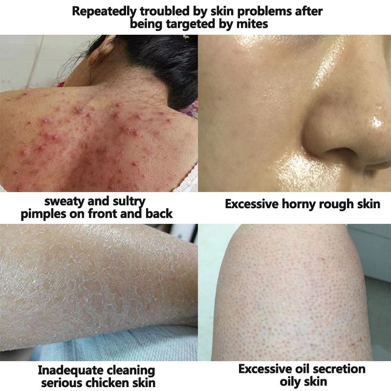Acne body wash 300ml Body Cleanser Back Mite Removal Antibacterial Deep ...