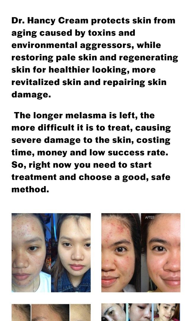 Dr.Hancy white spot cream, Beauty & Personal Care, Face, Face Care on ...