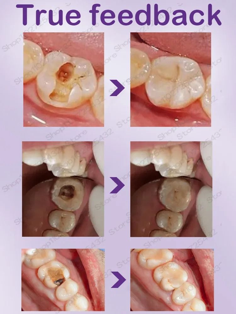 Tooth decay repair Repair all tooth decay, cavities and protect teeth ...