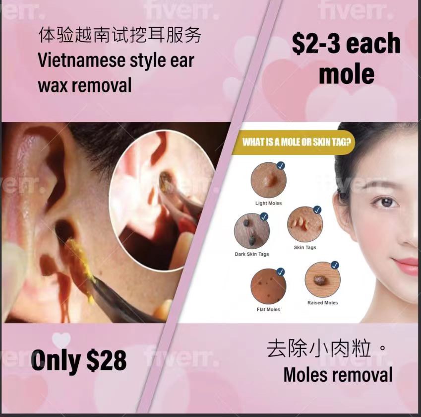 Vietnam Ear Wax Removal & Moles Removal, Beauty & Personal Care, Ear ...