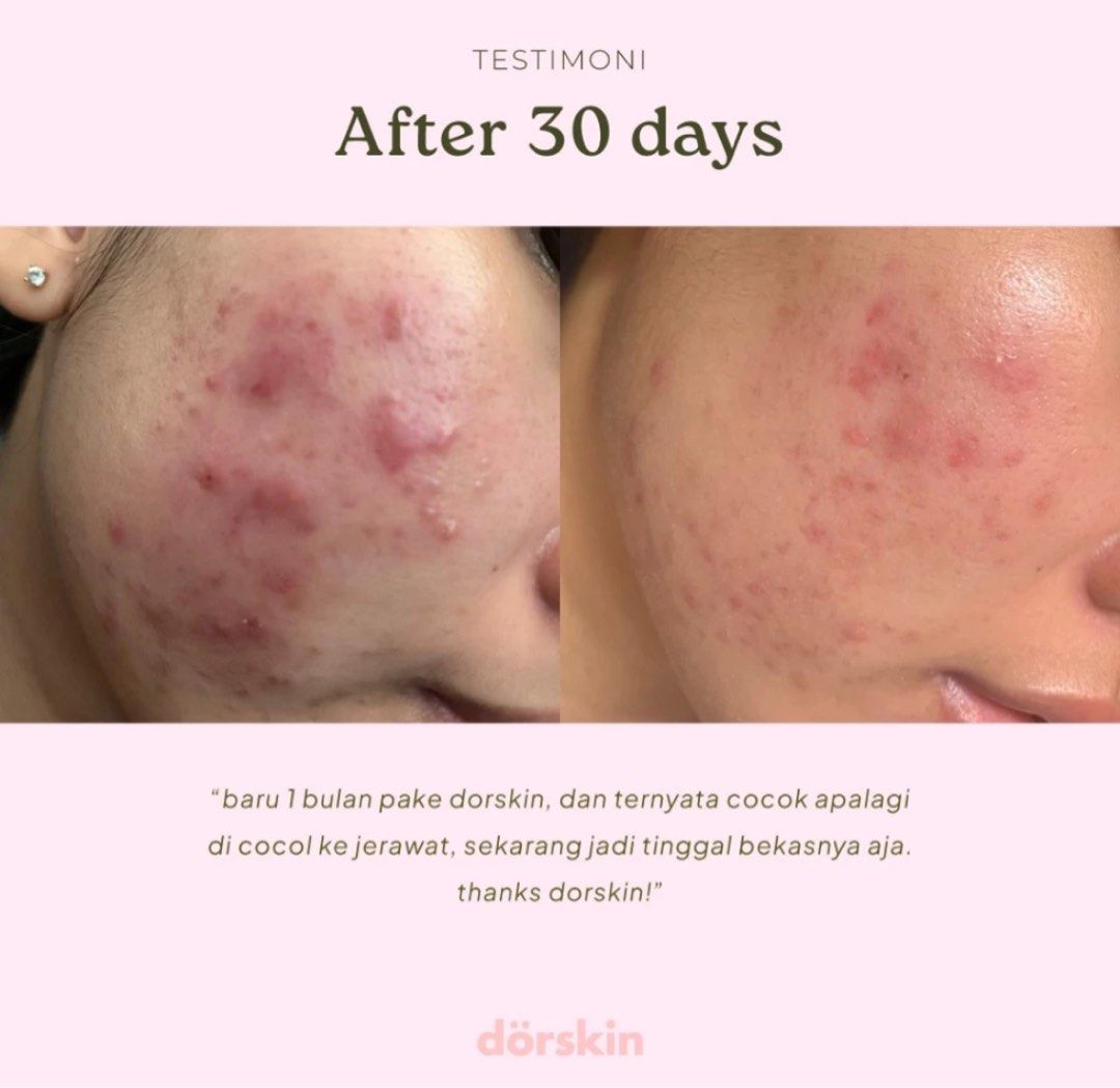 Dorskin Matcha Glow Sleeping Mask Acne Brightening Pelembab, Kesehatan ...