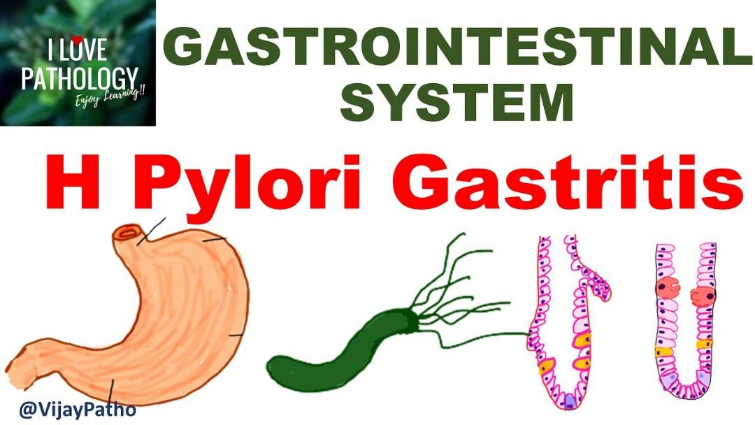 Stomach Gastritis H Pylori, Health & Nutrition, Health Supplements ...