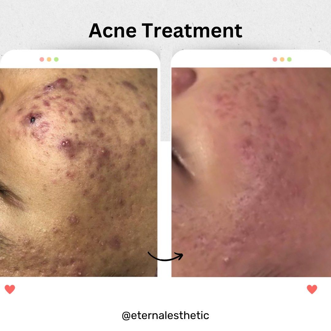 Models for Acne , Scars Skin Condition, Beauty & Personal Care, Face ...