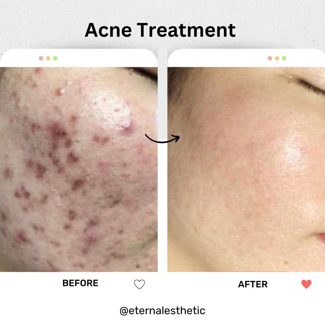 Models for Acne , Scars Skin Condition, Beauty & Personal Care, Face ...