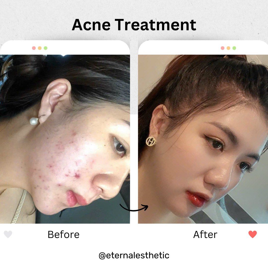 Models for Acne , Scars Skin Condition, Beauty & Personal Care, Face ...