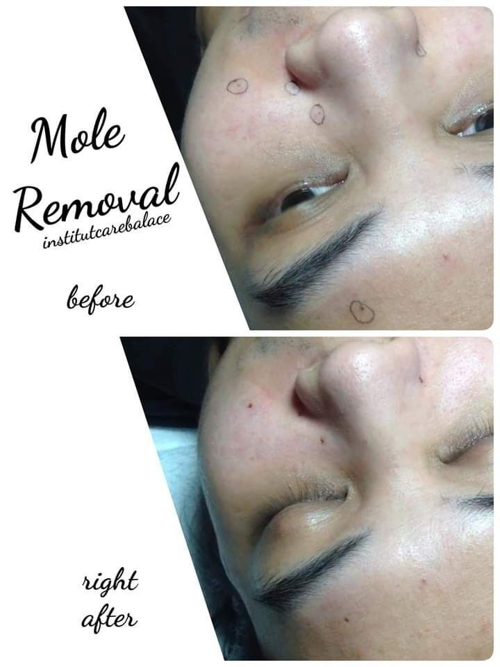 Skin Tag,Milia Seed ,Wart﻿,Syringoma,Tiny Bump,Oil Clog,Xanthelasma ...