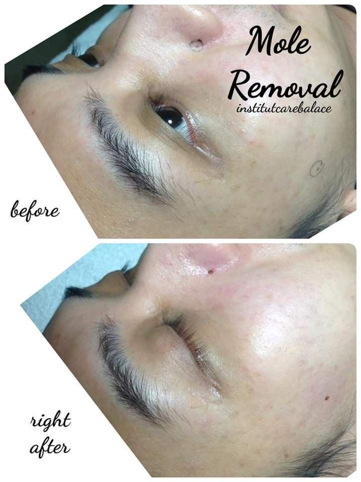 Skin Tag,Milia Seed ,Wart﻿,Syringoma,Tiny Bump,Oil Clog,Xanthelasma ...