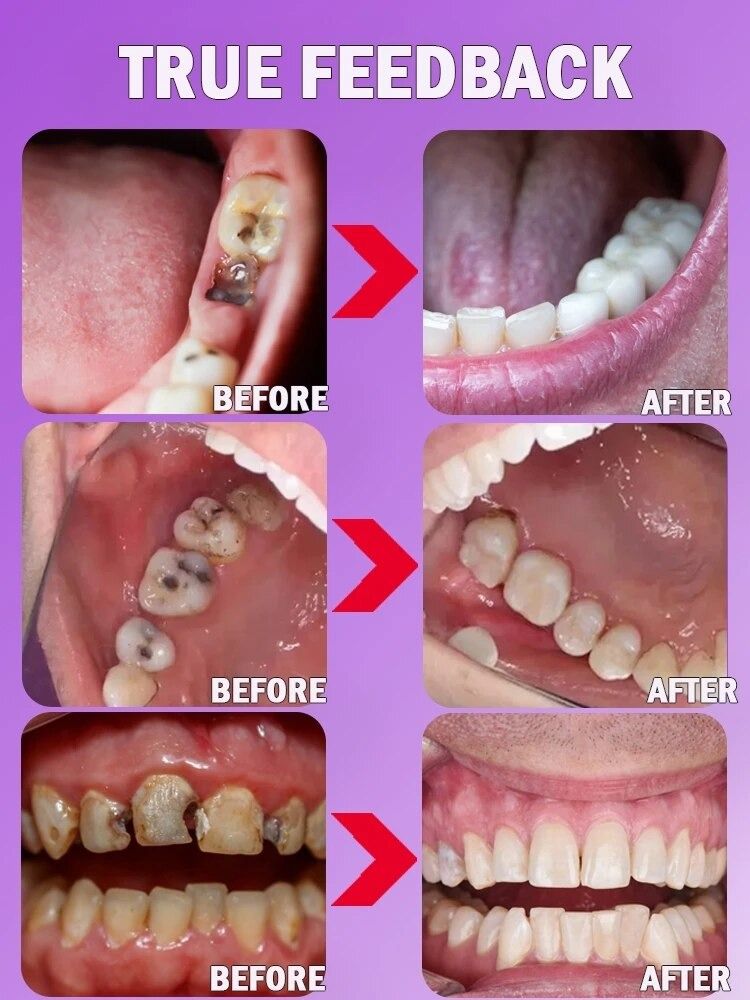 Tooth Decay Repair Foam Mousse Quick Repair of Cavities Caries Protect ...