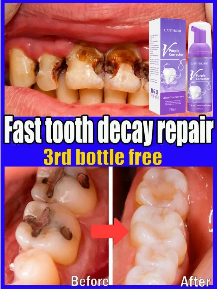 Tooth Decay Repair Foam Mousse Quick Repair of Cavities Caries Protect ...