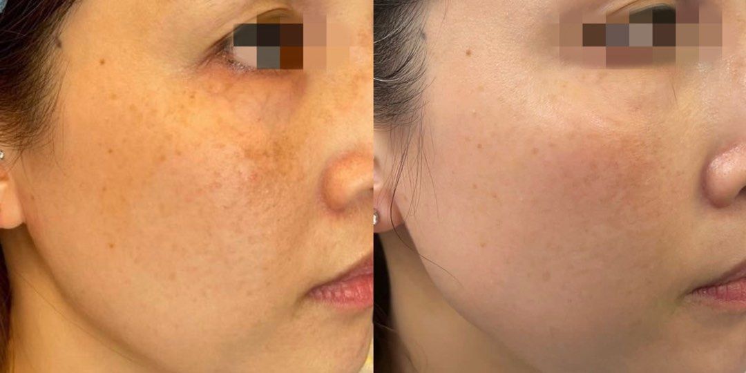 Jan Promo: Non Chemical Natural Cocktail- Melasma & Pigmentation ...