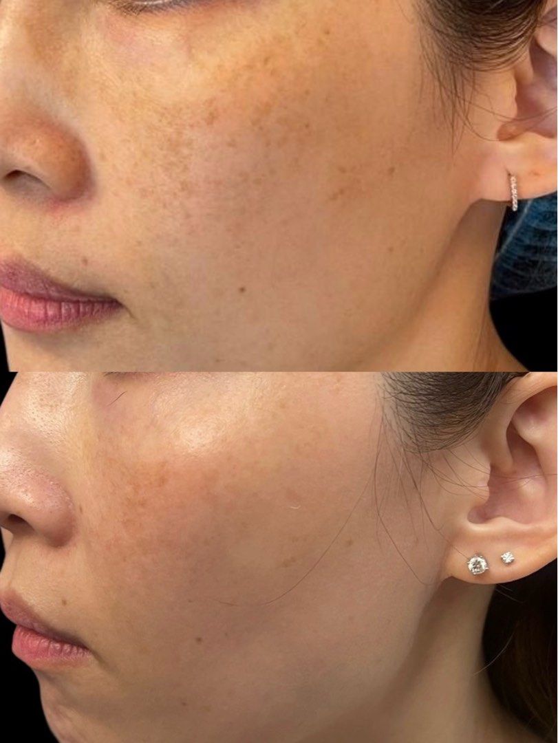 Dec Promo: Melasma Treatment (100% improvement!) freckles, sun damaged ...