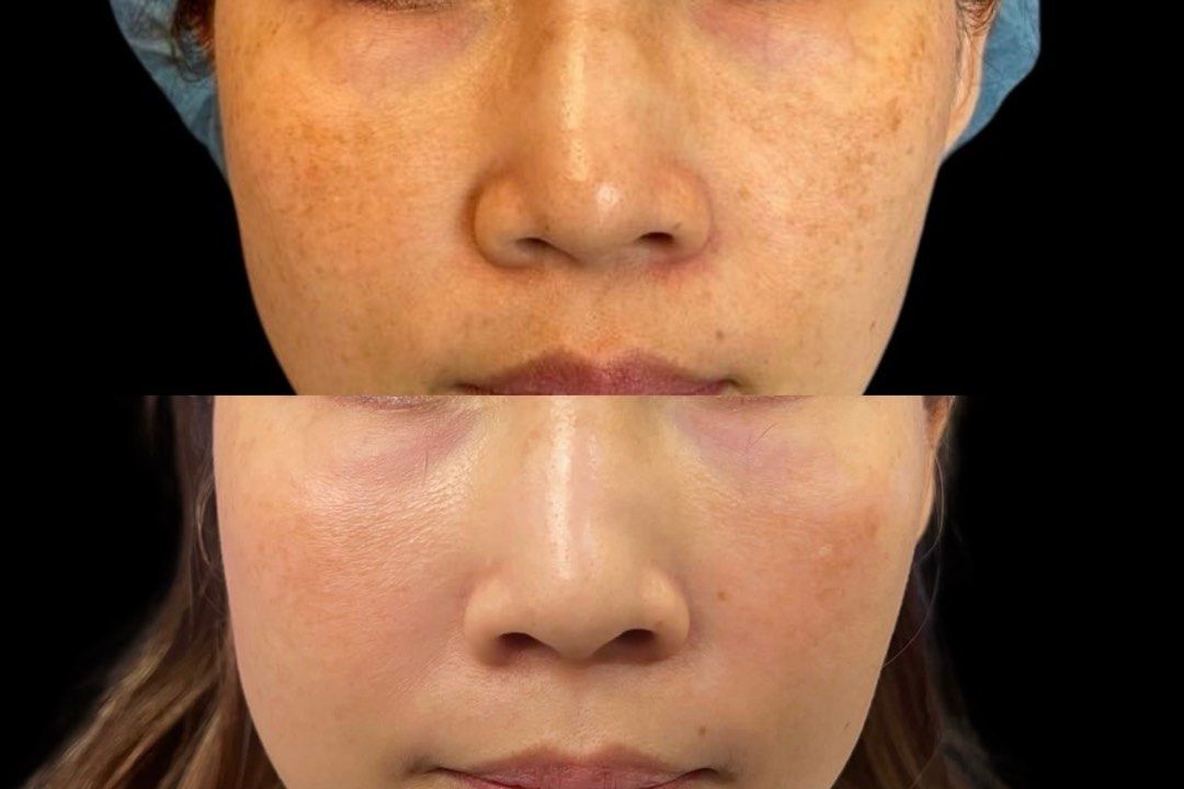 Jan Promo: Non Chemical Natural Cocktail- Melasma & Pigmentation ...