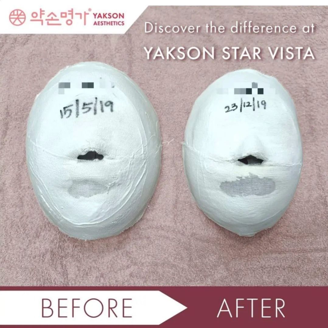 Yakson Small Face Resizing (Korean Golki / V-line Non-invasive treatment), Beauty & Personal ...
