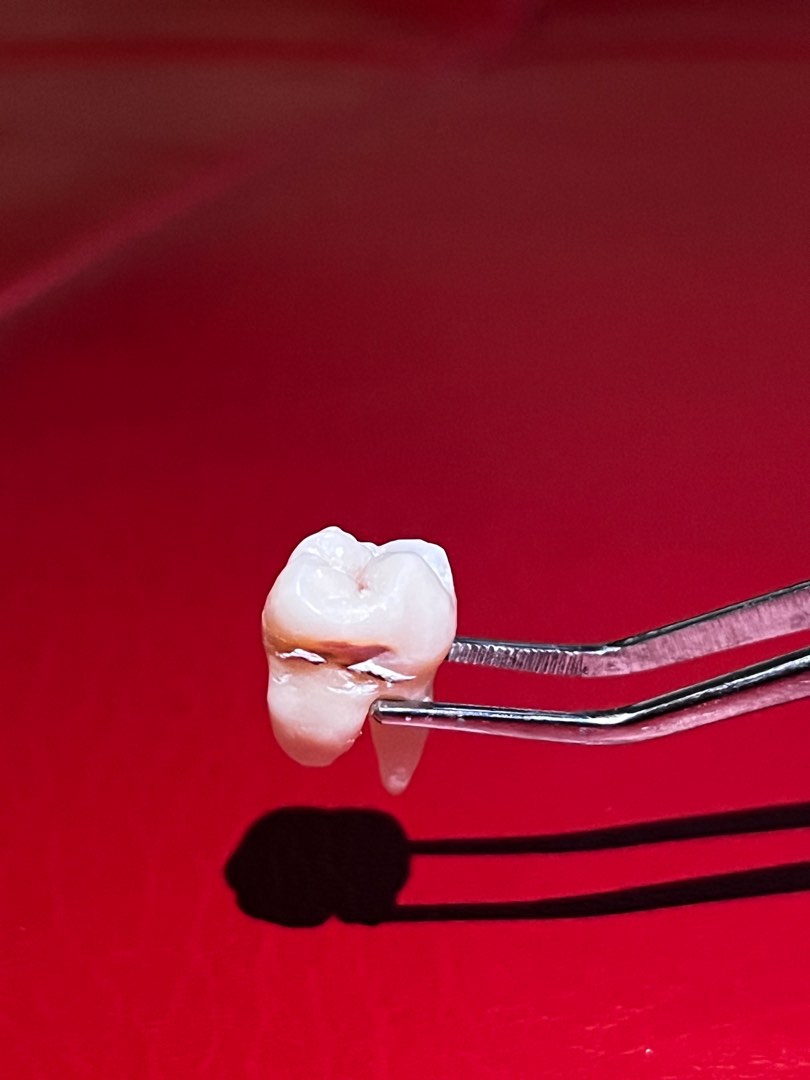 Molars Natural Teeth, Health & Nutrition, Medical Supplies & Tools on ...