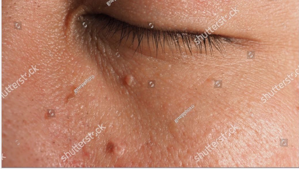 LF Facial Model: Skin Tag Removal, Beauty & Personal Care, Face, Face ...