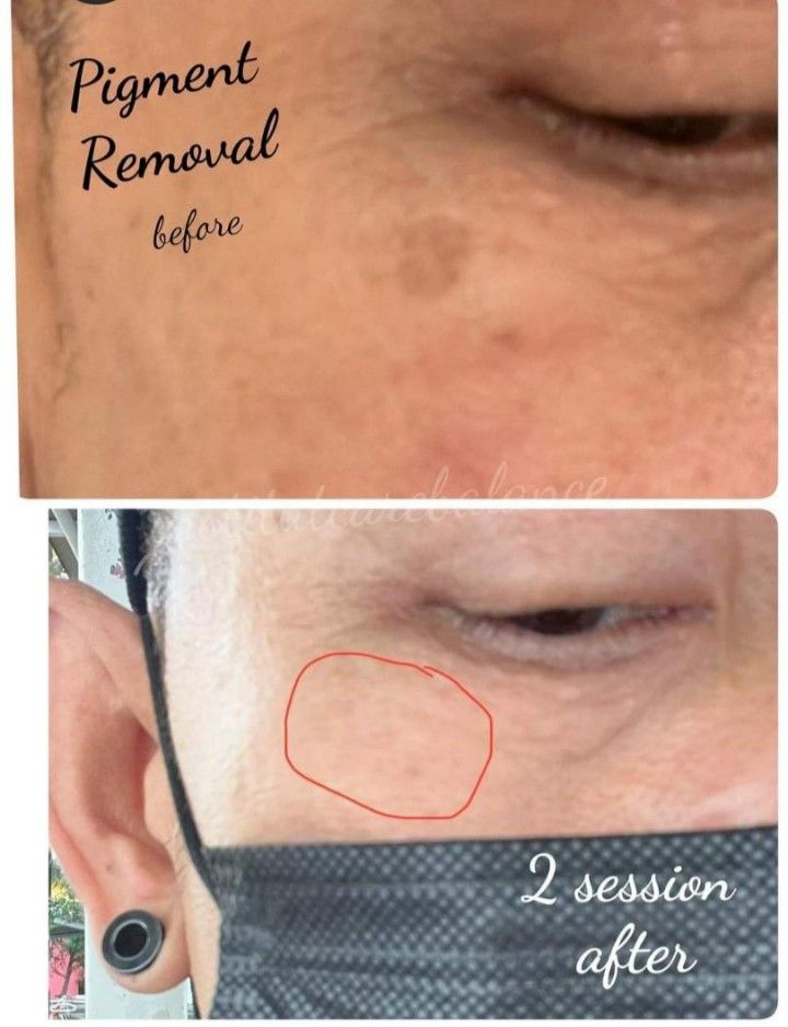 Pigmentation ,Age Spot, Freckles, Melasma,Lentigo,Sun Spot,Dark Spot ...