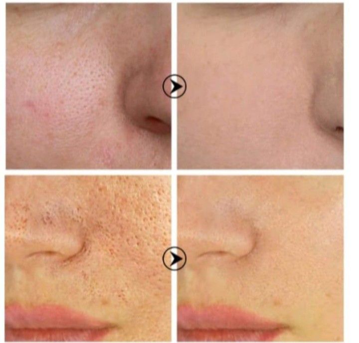 Pigmentation ,Age Spot, Freckles, Melasma,Lentigo,Sun Spot,Dark Spot ...