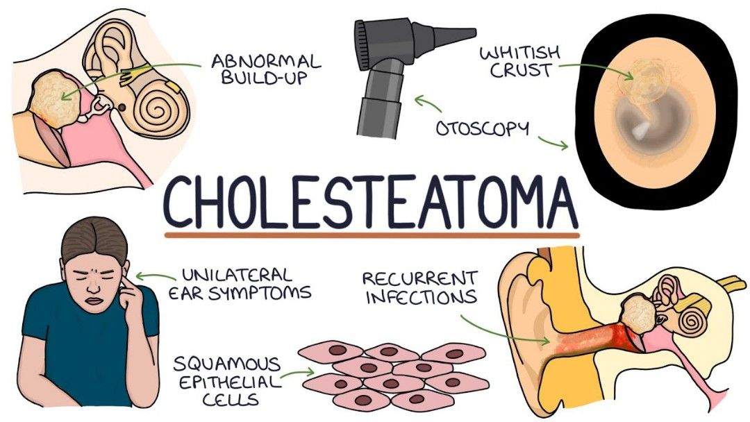 Cholesteatoma eye, ear, Health & Nutrition, Health Supplements ...