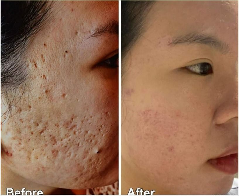 Stem Cell DNA / Fractional RF Microneedling / Plasma Repair Acne Scars ...