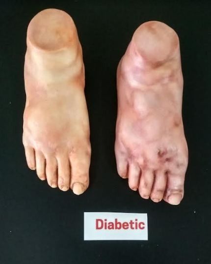 "diabetes foot modeling for display" Public Education"Will make based ...