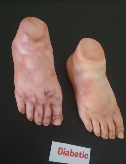 "diabetes foot modeling for display" Public Education"Will make based ...