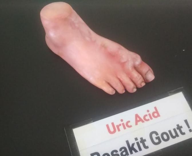 Gout ! "Uric acid foot condition for display Public Education"Will make ...