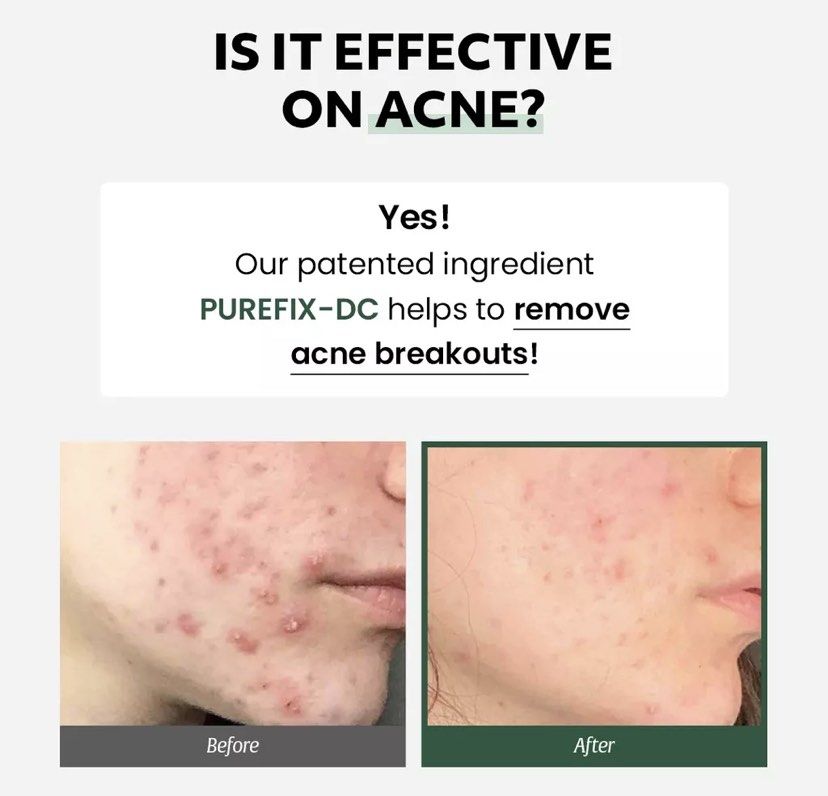[ Blanc Nature Official ] Acne Pimple Face Cleanser Cleansing foam ...
