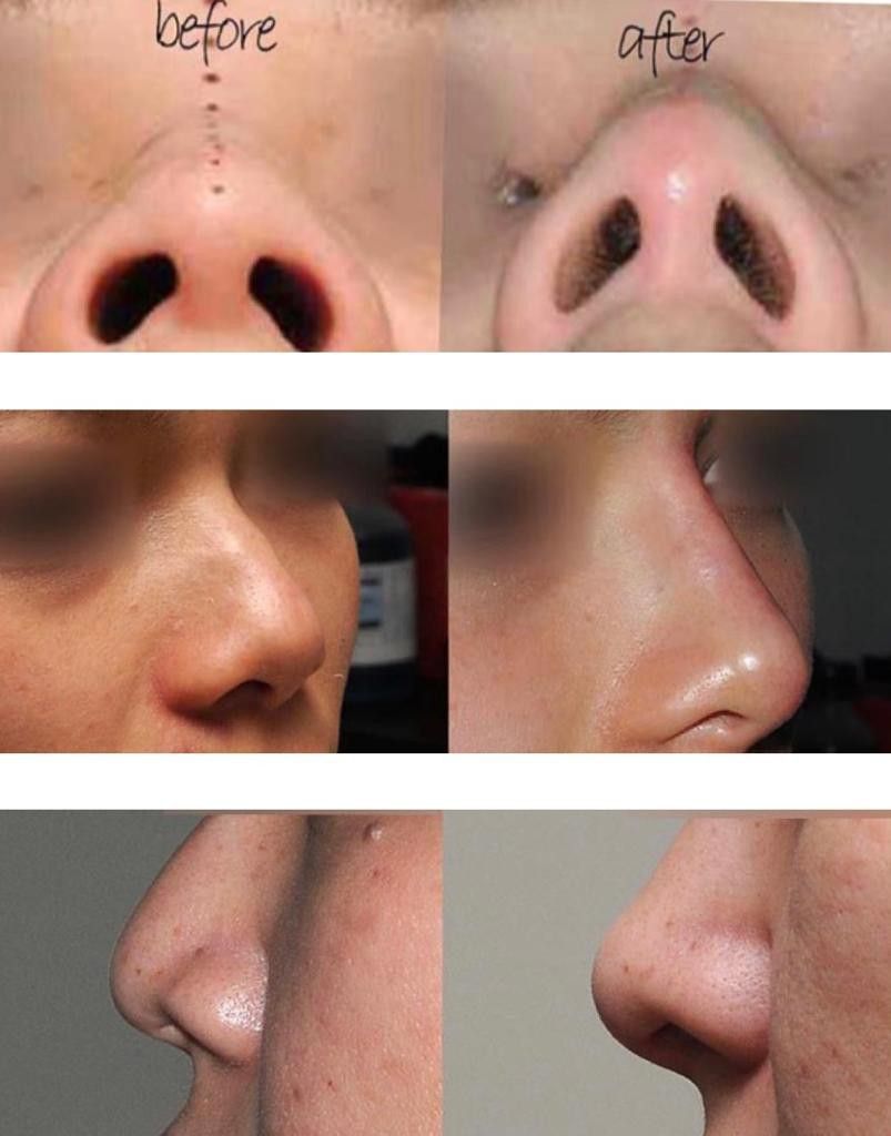 Sharper higher nose, Beauty & Personal Care, Face, Face Care on Carousell