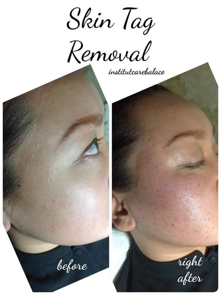 Mole ,Milia Seed﻿,Skin Tag,Wart﻿,Syringoma,Tiny Bump,Oil Clog,Xanthelasma,Cholesterol,Sebaceous ...