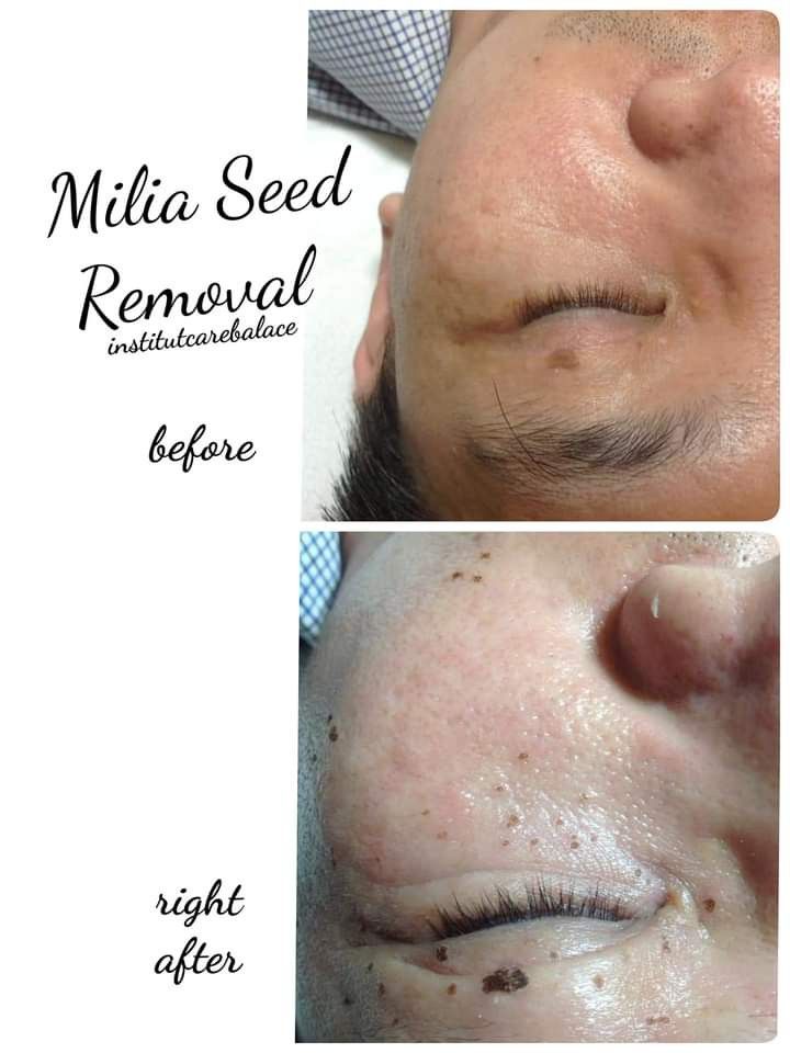 Mole ,Milia Seed﻿,Skin Tag,Wart﻿,Syringoma,Tiny Bump,Oil Clog ...