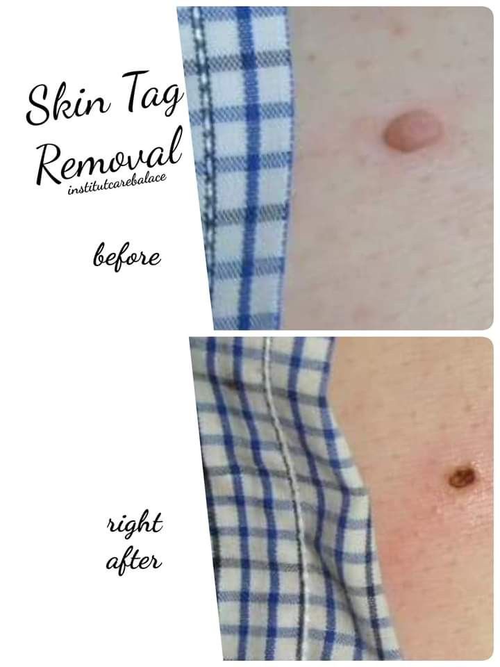 Mole ,Milia Seed﻿,Skin Tag,Wart﻿,Syringoma,Tiny Bump,Oil Clog,Xanthelasma,Cholesterol,Sebaceous ...
