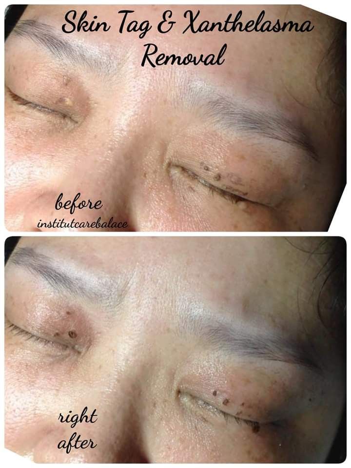Mole ,Milia Seed﻿,Skin Tag,Wart﻿,Syringoma,Tiny Bump,Oil Clog,Xanthelasma,Cholesterol, Sebaceous ...