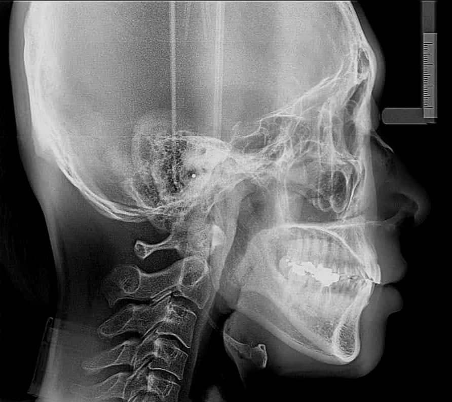 Panoramic & Cephalometric X-ray + TMJ, Health & Nutrition, Medical ...