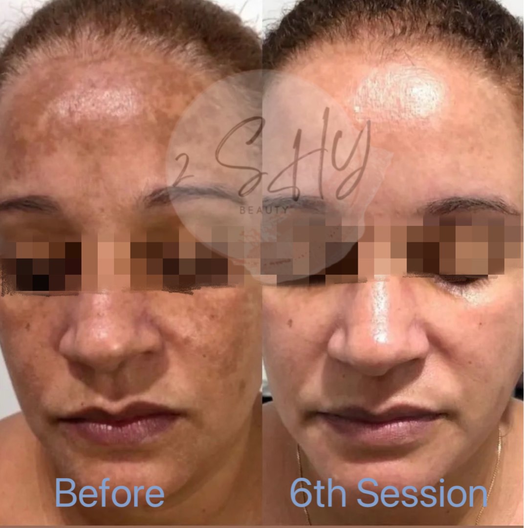 Melasma Treatment (100% improvement!) freckles, sun damaged, dermal ...