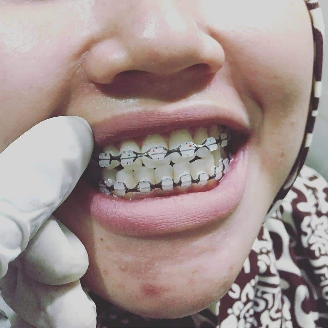 PASANG KAWAT GIGI FASHION, Kesehatan & Kecantikan, Kulit, Sabun & Tubuh ... PASANG KAWAT GIGI FASHION, Kesehatan & Kecantikan, Kulit, Sabun & Tubuh ...