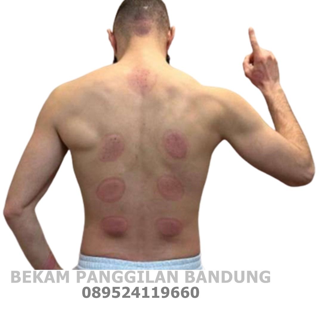 Bekam panggilan bandung jawa barat 089524119660 bekam bandung ciparay ... Bekam panggilan bandung jawa barat 089524119660 bekam bandung ciparay ...