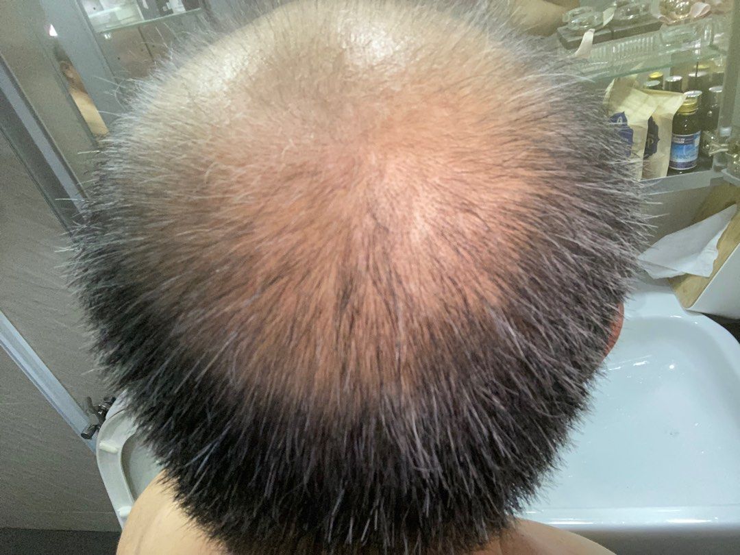 Grow Hair Reverse Hair Thinning Hair Loss Balding Beauty And Personal