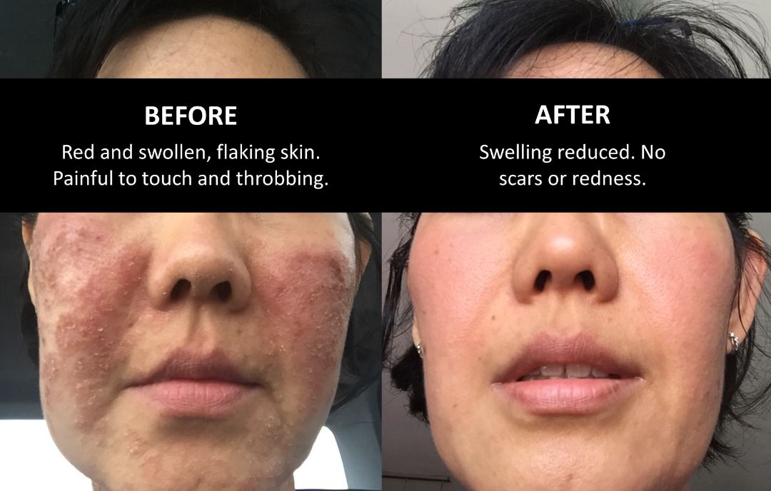 Y-Not Natural Omega 3, 6 & 9 Australian 100% Pure Emu Oil for Eczema ...