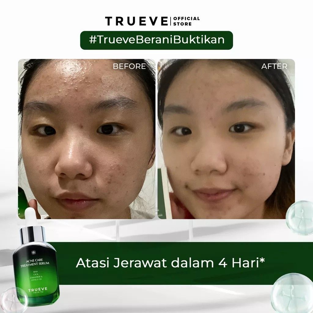 TRUEVE Acne Care Treatment Serum (BHA + SALICARE (Salicylic Acid ...