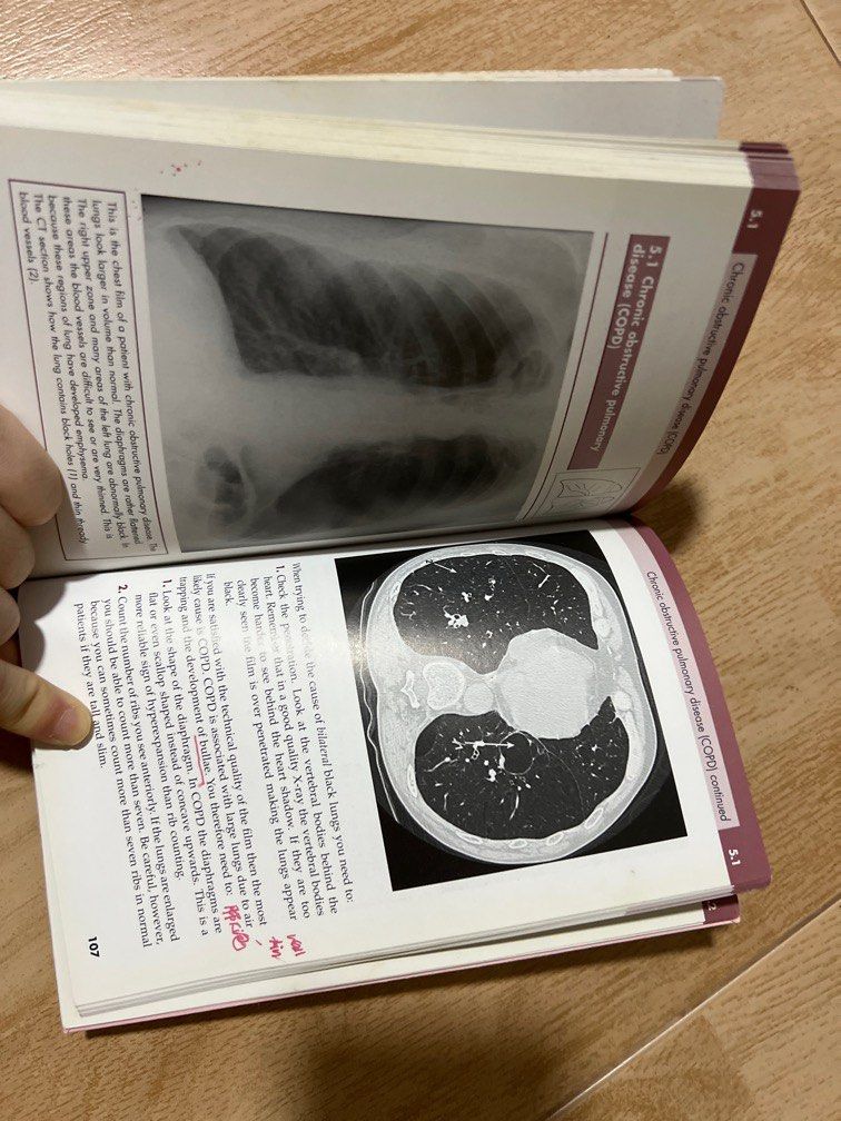 Chest X- ray made easy book , Hobbies & Toys, Books & Magazines ...