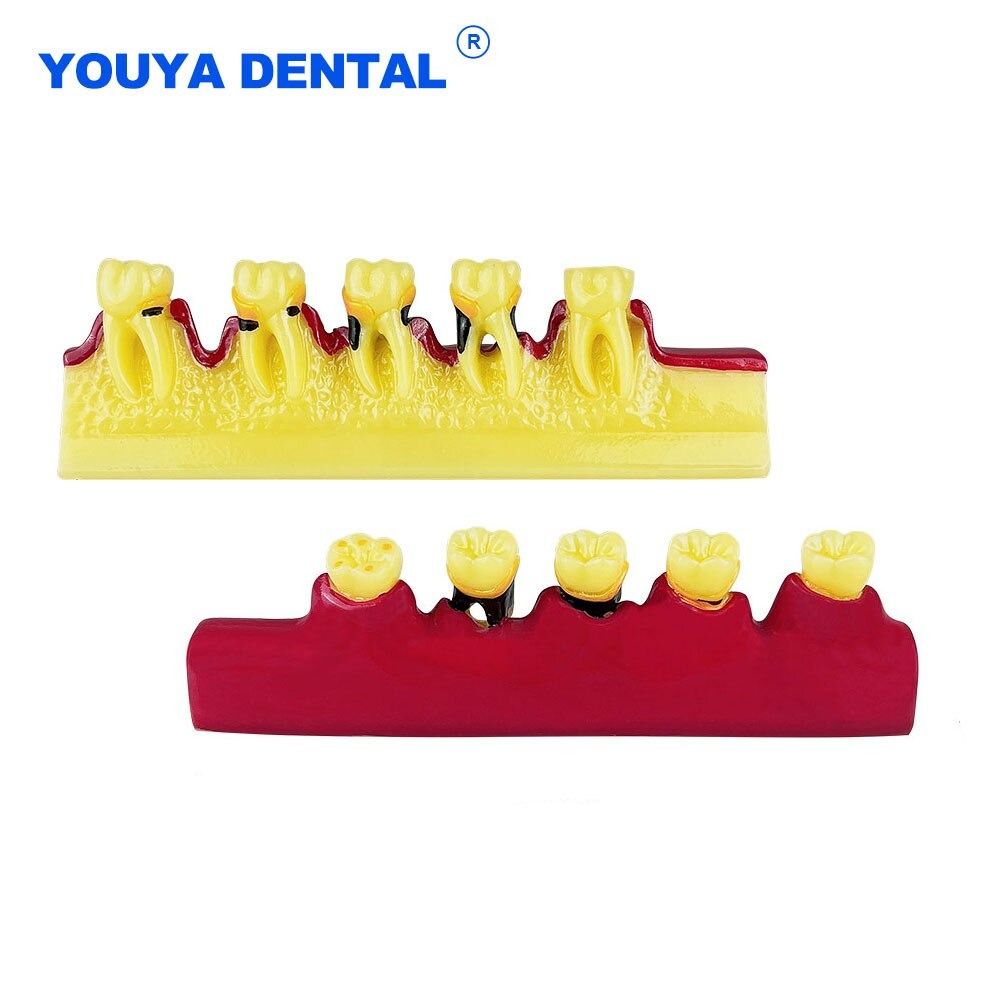 Periodontal Teeth Model 5 Stages Dental Disease Teeth Model Typodont ...