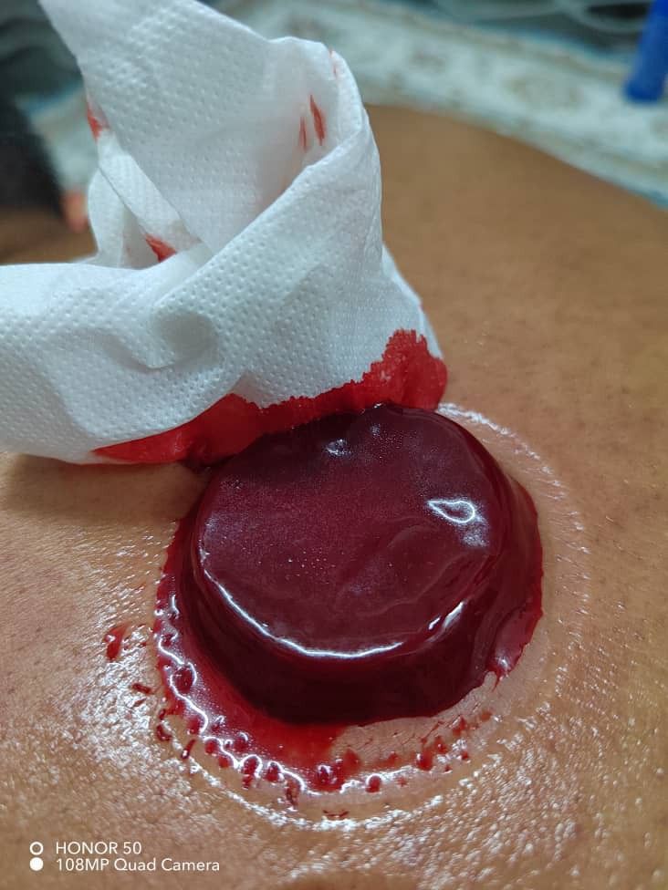 Urutan bekam muka, Beauty & Personal Care, Face, Face Care on Carousell