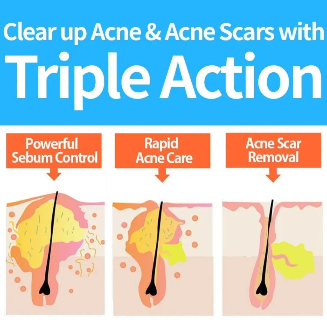 [ Blanc Nature Acne Scar Cream / Snail Cream / No.1 in Removing Acne ...