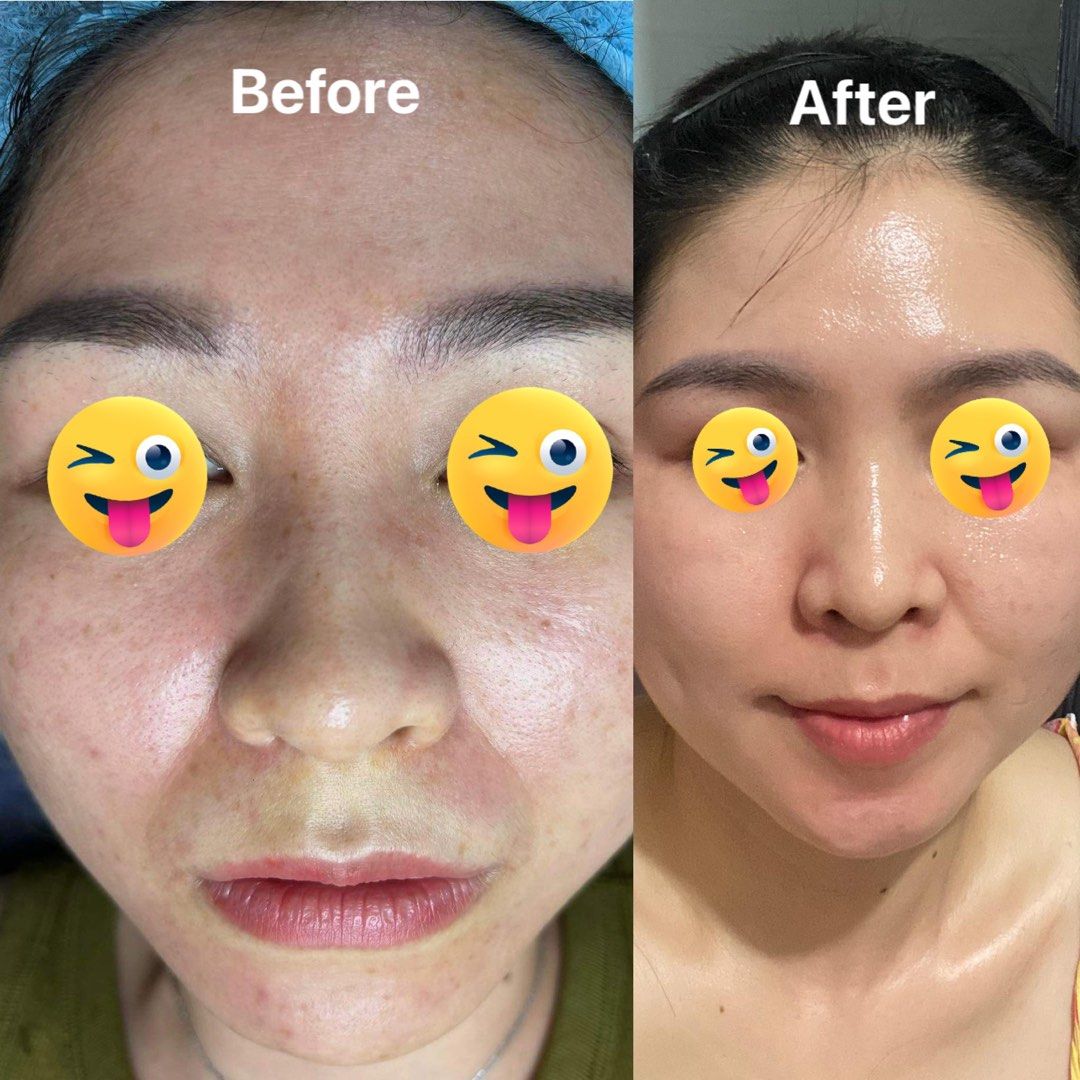 Freckle removal _get rid of your freckle to rejuvenate skin, Lifestyle ...