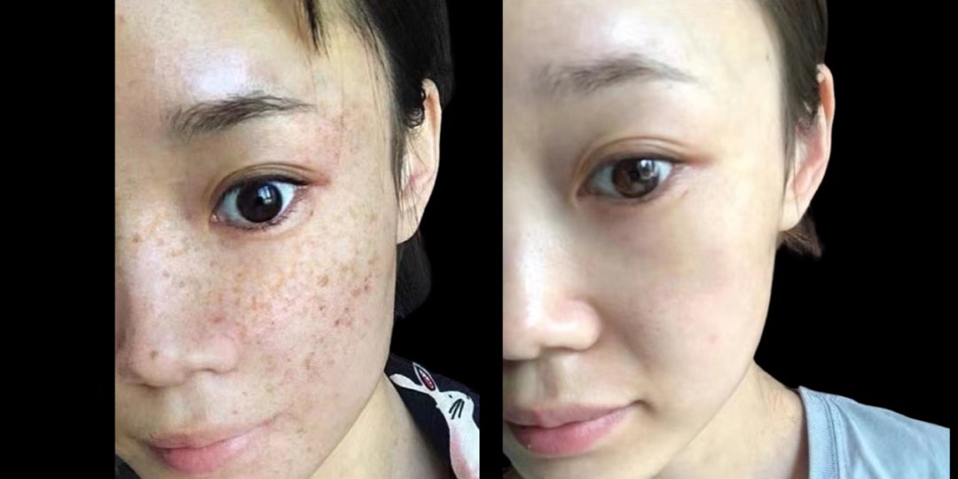 Hyperpigmentation , Pigmentation & dark spots treatment (Melasma ...