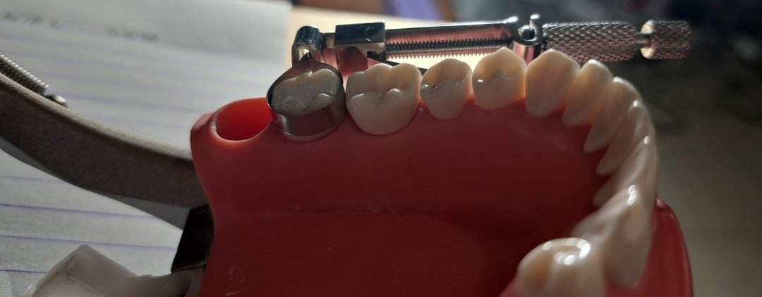 Tofflemire matrix band, Health & Nutrition, Medical Supplies & Tools on ...