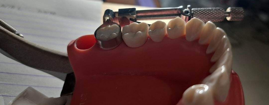 Tofflemire matrix band, Health & Nutrition, Medical Supplies & Tools on ...