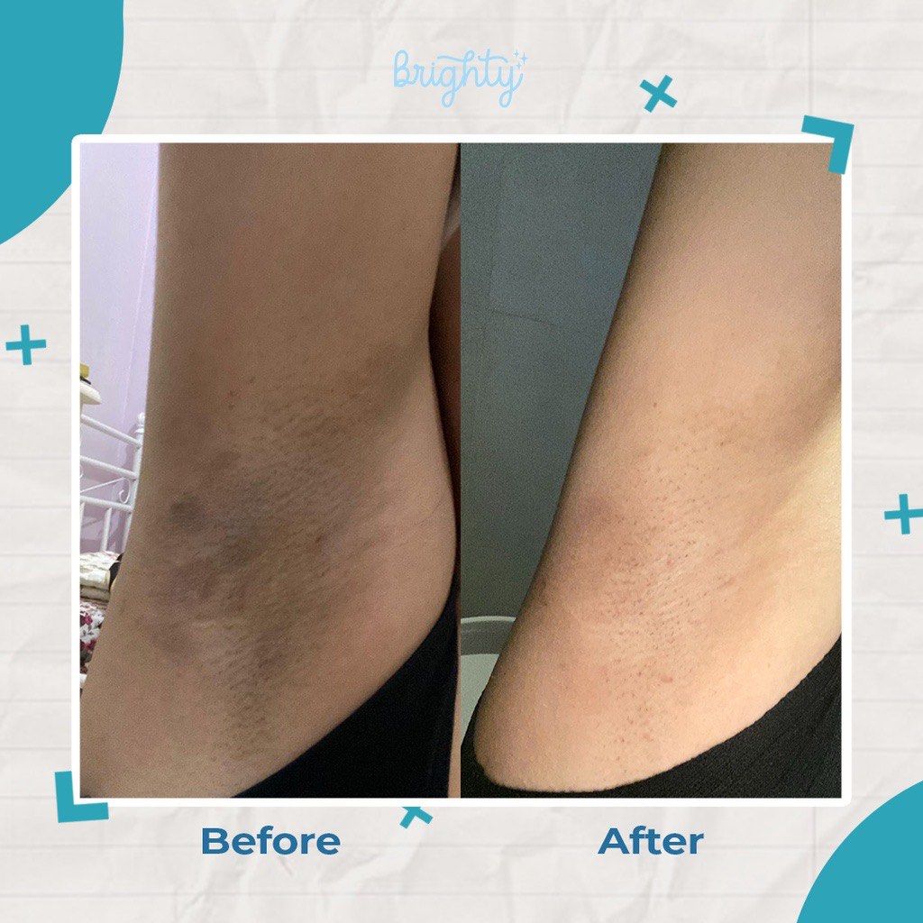 Brighty Aha Hero Exfoliating Liquid Serum Pencerah Ketiak / Jerawat ...